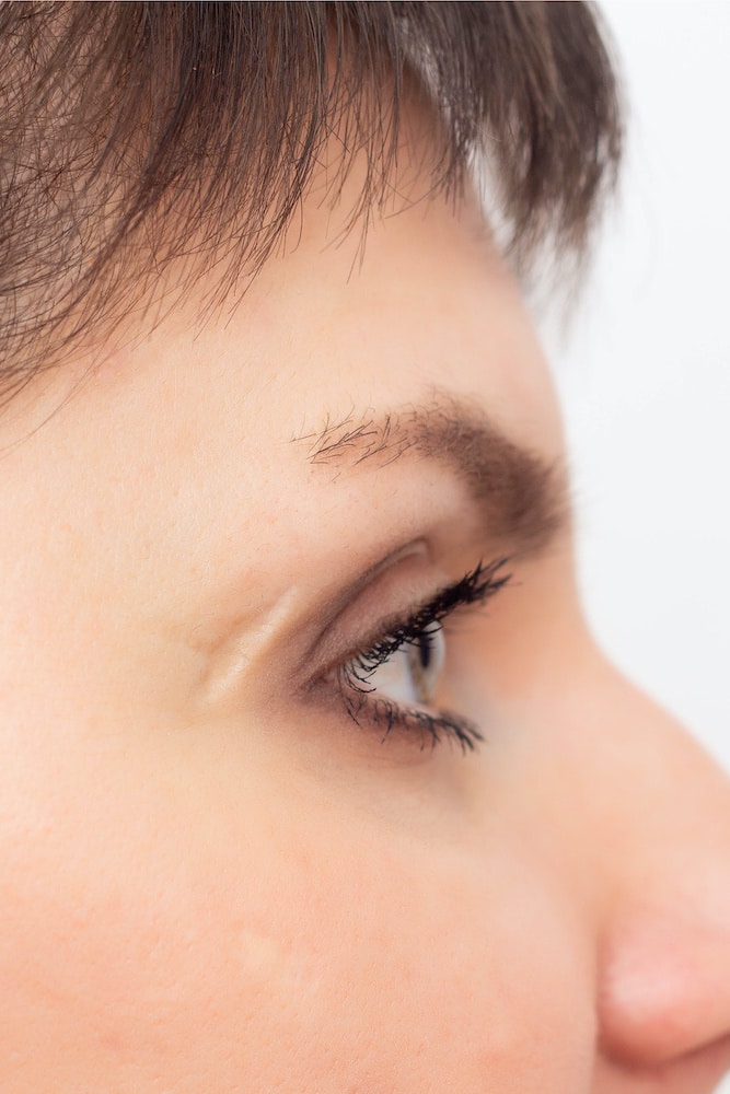Scar Revision in Minnesota | Midwest Facial Plastic Surgery